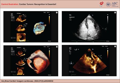 Cardiac Tumors Recognition Is Essential Abc Imaging