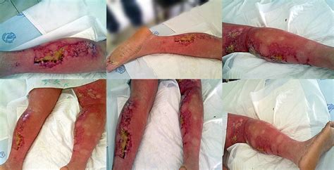 Tutomedic Imagen De La Semana Eritrodermia Psoriásica