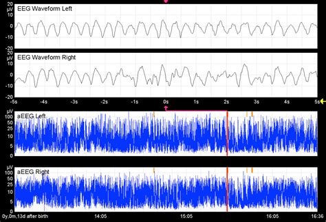 Application Of An Amplitude Integrated Eeg Monitor Cerebral Function Monitor To Neonates