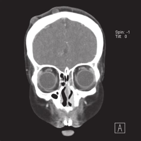 Histopathologic Examination Of The Nodules On The Scalp Shows A Cystic Histopathologic Examination Of The Nodules On The Scalp Shows A Cystic