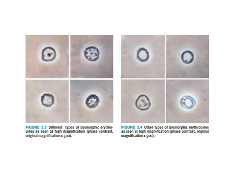 Urine Microscopy Ppt