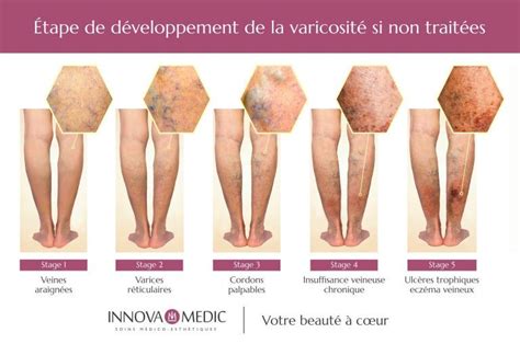 Traitement Des Varices Innova Medic Votre Beauté à Coeur