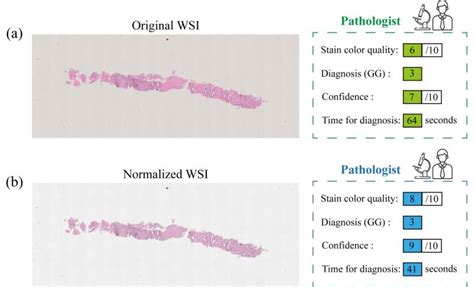 Impact Of Stain Normalization On Pathologist Assessment Of Prostate Cancer A Comparative Study