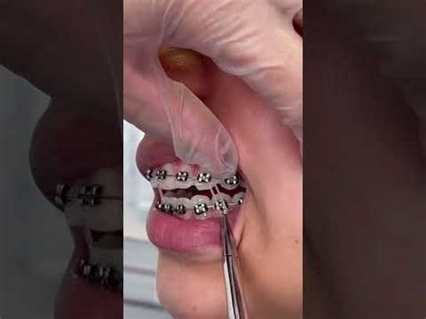Elásticos Intermaxilares En Ortodoncia Para Una Sonrisa Perfecta | Ortodoncia Junin