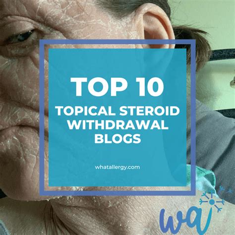Discover The Best Topical Steroid Withdrawal Blogs What Allergy Blog