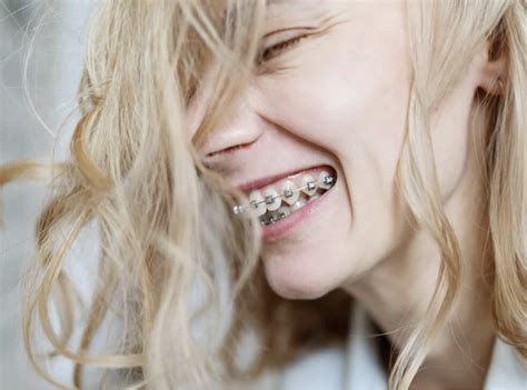 თვითლიგირებადი ბრეკეტები Breketebi Ge