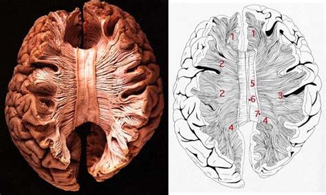 Corpus Callosum The Corpus Callosum Is A Large