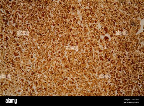 Spirocheteen Of The Syphillis Liver Tissue Under The Microscope 200x