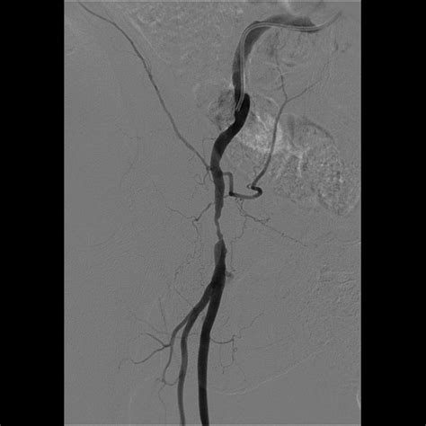 Cutter Plaque Excision System In A Case Of Common Femoral Artery