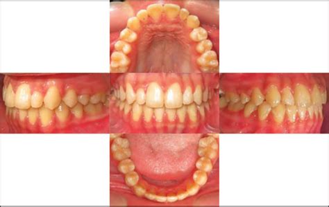 Management Of Skeletal Class Iii Malocclusion With Unilateral Crossbite On A Growing Patient