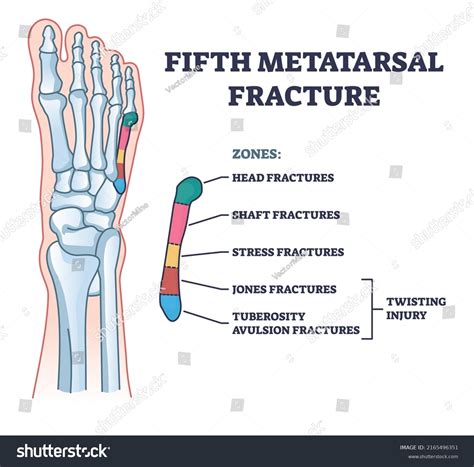 Metatarsal Bone Fracture