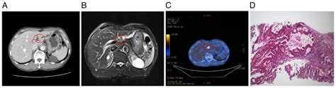 Intrahepatic Cholangiocarcinoma Initially Diagnosed As Adenocarcinoma Of Unknown Primary With