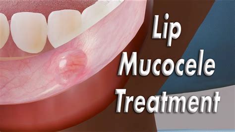 Mucocele Oral Descubre Las Causas Tratamientos Efectivos Y Cómo