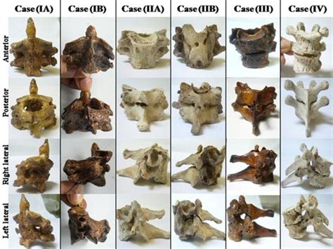 Shows Photographs Of Block Vertebrae Taken From Anterior Posterior Download Scientific
