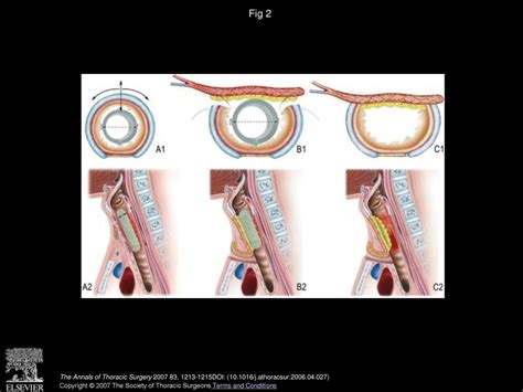 Long Segment Tracheal Stenosis Treated With Vascularized Mucosa And Short Term Stenting Steven