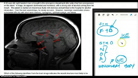 Mammillary Bodies Mri