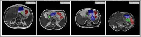 medical image segmentation using 🤗 huggingface and pytorch