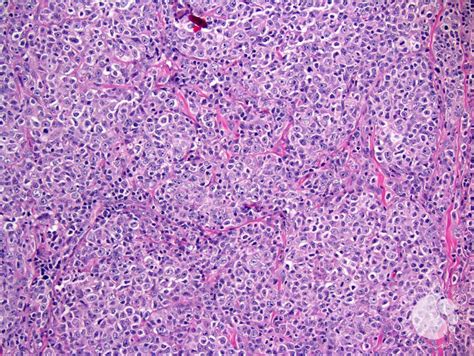 Follicular Lymphoma Grade 3b 1