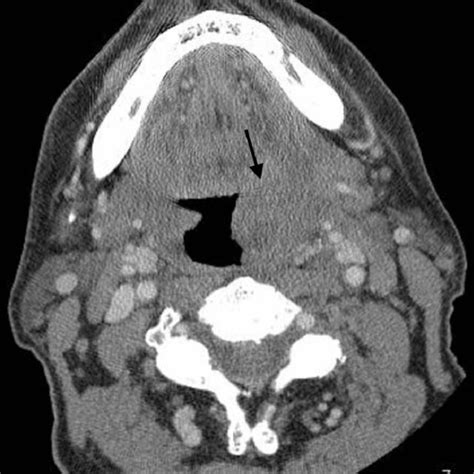 Initial Ct Scan With Iv Contrast Of Left Palatine Tonsillar Mass Before Download Scientific
