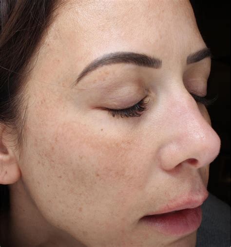 The Hyperpigmentation Solution