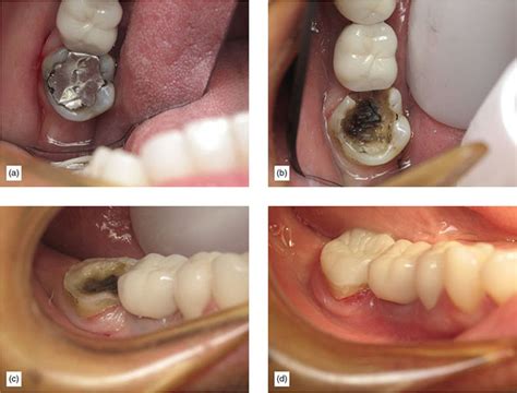 The Healthier Paradigm Supragingival Minimally Invasive Adhesive