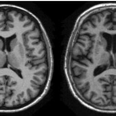 Single Slice Of Mr Images Labeled Cdr0 Cdr05 Cdr1 Cdr2