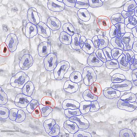 Immunohistochemistry For Foxp3 Staining In Breast Cancer Tissue