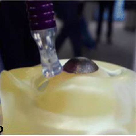 Proper Mp3 Probe Angle And Placement During Micropulse G6 Glaucoma Download Scientific Diagram