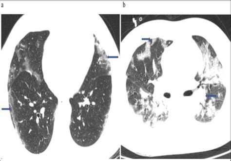 A Hrct Lung Axial Sections Show Peripheral Distribution Pattern Blue