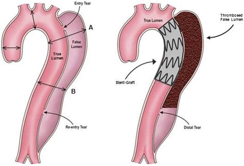type b dissection management