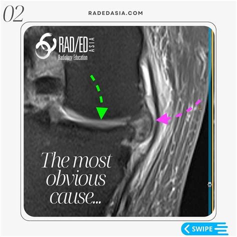 Knee Mri Meniscus Root Tear Extrusion Radedasia