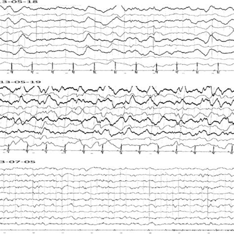 Electroencephalograms Performed At The Beginning A B And At The End Download Scientific