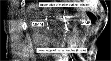Assessment With Cone Beam Computed Tomography Of Intrafractional Motion And Interfractional