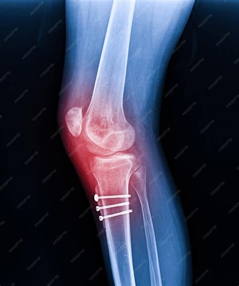 Premium Photo Xray Knee Joint Fracture Proximal Tibia And Post Fix
