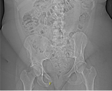 Diastatic And Asymmetric Pelvis In A Woman With Classic Bladder Exstrophy Download Scientific