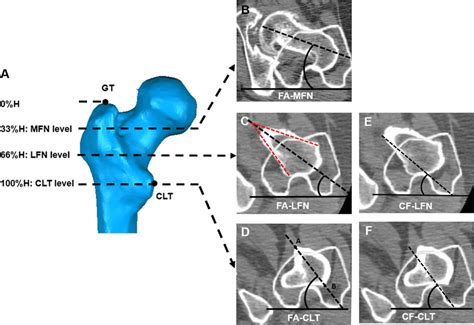 Measurement Of Proximal Femoral Anatomical Parameters A Three Slice