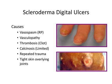 Skin Manifestations Of Scleroderma By Dr Lorinda Chung Md Pptx Skin And Dermatology