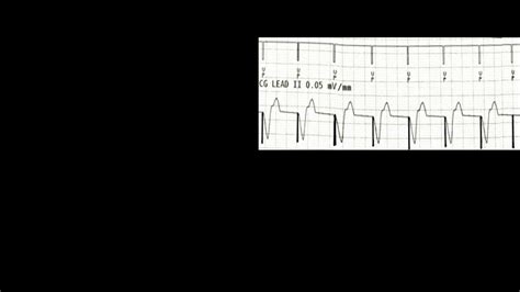 Ekg Pacemaker Threshold Simulations Mobile