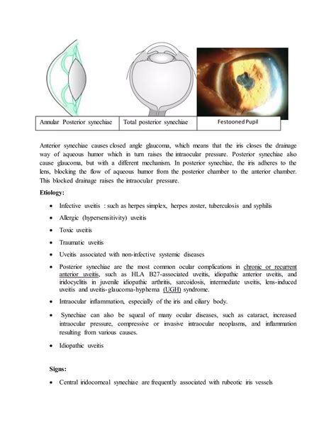 Synechia Docx