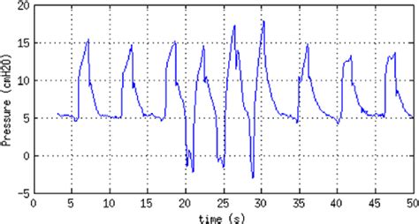 Demonstration Of The Assisted Ventilation Mode Superimposed On A