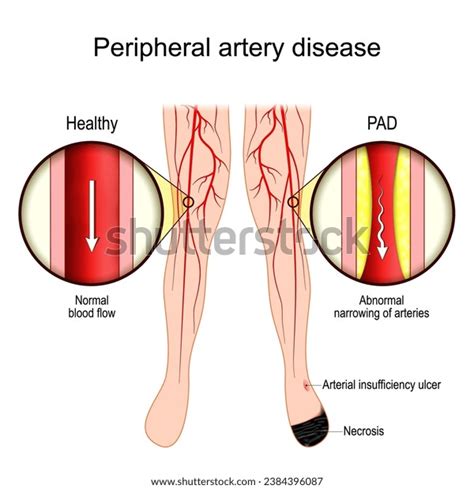 Peripheral Artery Disease Vascular Disease Cross Stock Vector Royalty Free 2384396087