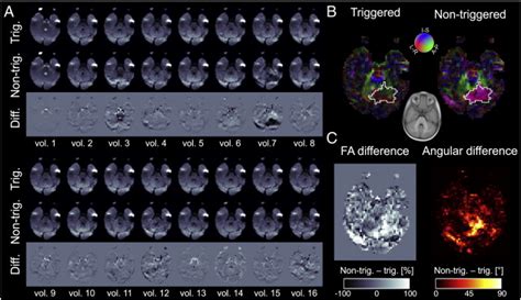 Pulsation Artifacts Affect The Tensor Estimation Download Scientific Diagram