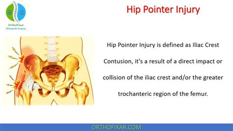Hip Pointer Injury Causes Symptoms And Treatment Mhmad Farooq Hip Pointer Injury Causes Symptoms And Treatment Mhmad Farooq