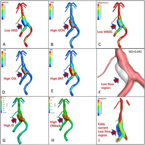 Proximal Basilar Fusiform Aneurysm Cloud Map A Wss B Gon C