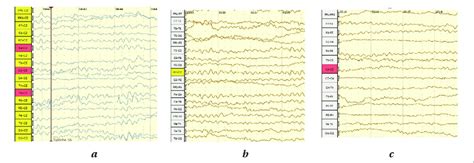 Eeg M B 23 Year Old Female Patient Note A The Ref Montage With