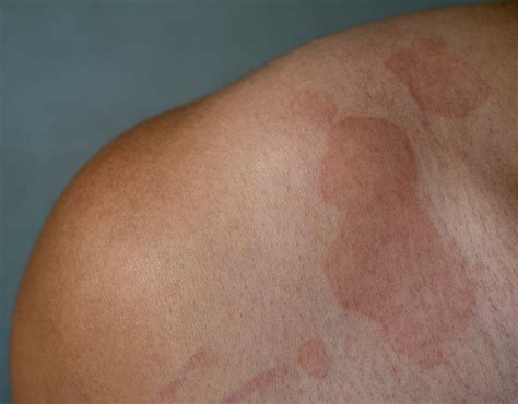 Tinea Versicolor — Medical Secrets