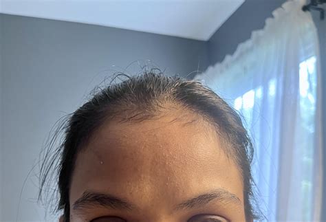 Inside Your Forehead Acne Face Map What Are Your Breakouts Telling