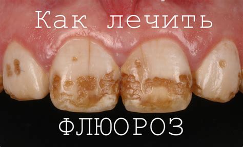 Флюороз. Лечение цельнокерамическими коронками. | White Crown
