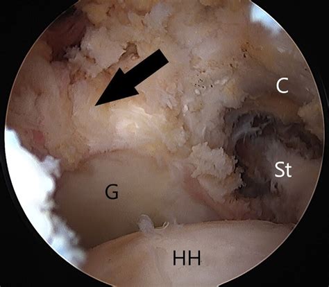 After Subacromial Bursectomy And Resection Of The Remaining Rotator Download Scientific Diagram