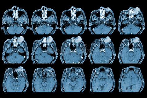 Ct Brain Axial Scans Hyperdense Mass With Homogeneous And Mild